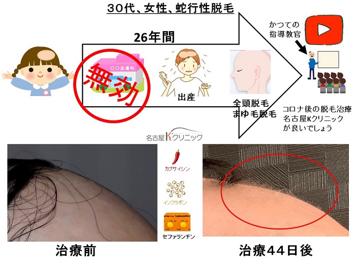 26年間不治の全頭脱毛の患者さん、治療44日後に産毛確認！ 患者様からの声・メディア掲載・クリニックからのお知らせ 名古屋kクリニック